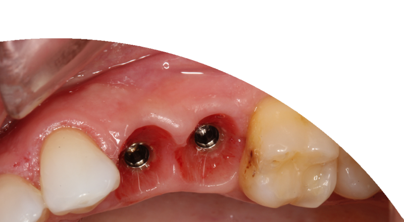 Thommen Medical US, der Schweizer Dentalimplantat Hersteller | Thommen ...
